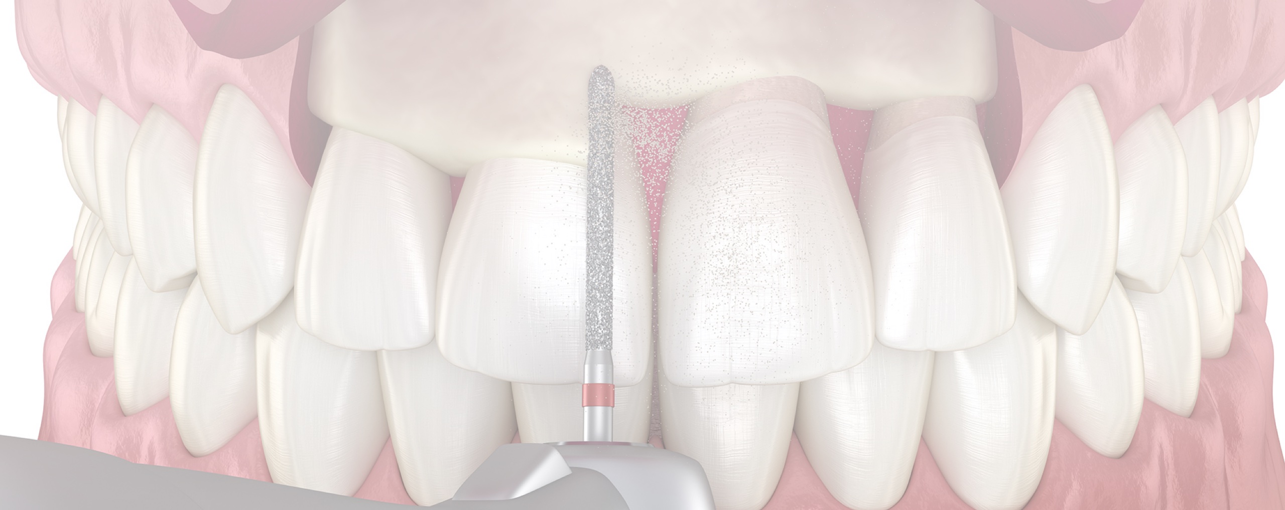 Crown Lengthening – Joseph Barclay
